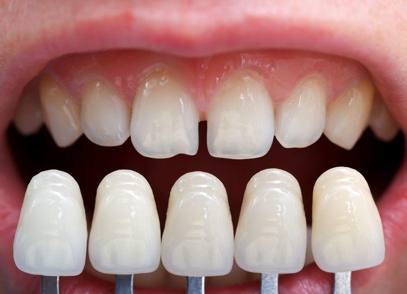 Όψεις πορσελάνης |Veneers| - Κληρονόμου Ιωάννα DDS